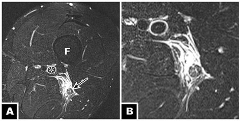 Post Block Mri Scan Showing Intrafascicular Fluid Accumulation Inside