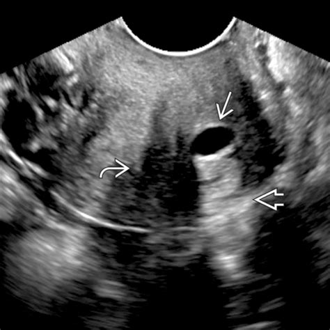 Nabothian Cyst Radiology Key