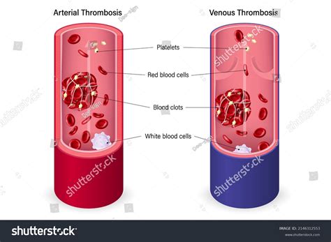 Arterial Embolism