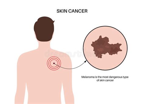 Skin Cancer Diagnosis Stock Illustration Illustration Of Tissue 274704285