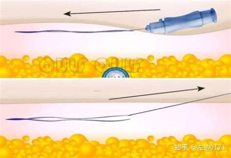 做线雕提升脸部好不好做一次线雕能维持几年 知乎