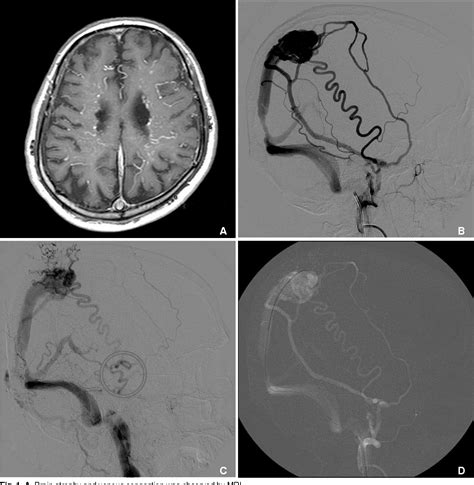 Figure 1 From Onyx Embolization Of Dural Arteriovenous Fistula Using Scepter C Balloon Catheter