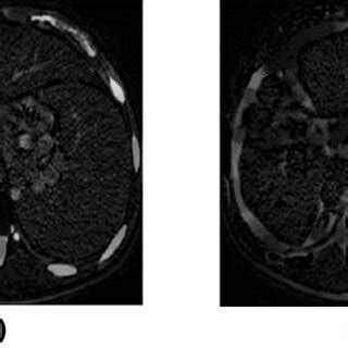 A Original Test CT Image B White Top Hat Transform Output Image C Black