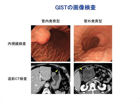 gist（消化管間質腫瘍）について① 治療法の紹介 浜松医科大学 外科学第二講座 浜松医科大学 第二外科医局 外科専門医をめざそう！