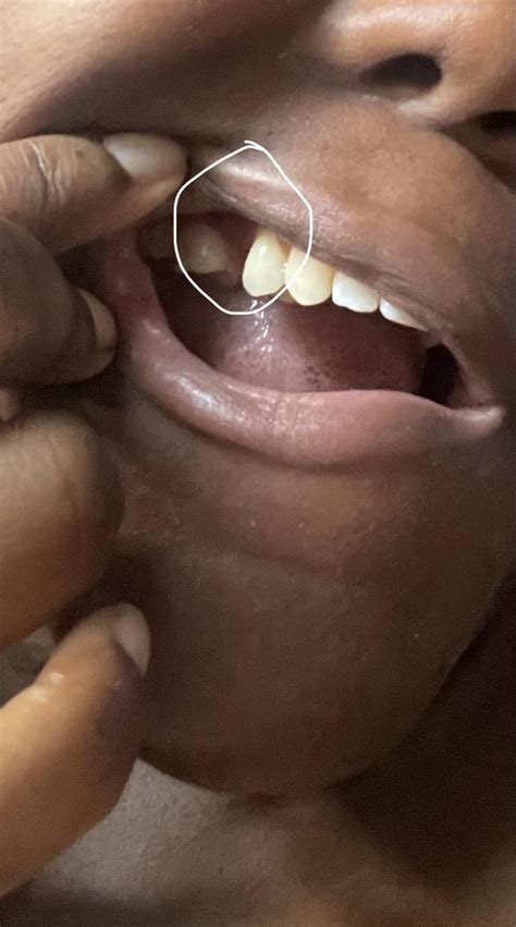 Replace Missing Tooth R Teeth