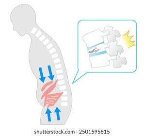 Illustration Person Compression Fracture That Causes Stock Vector Royalty Free