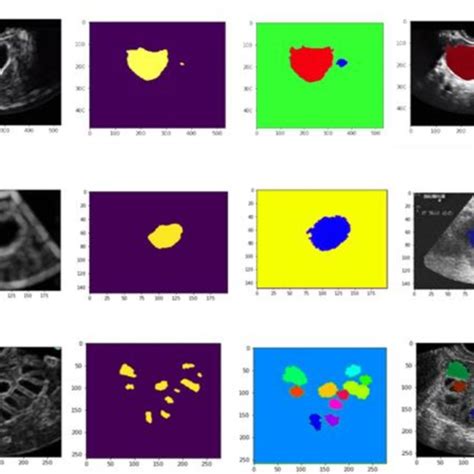 Segmentation Of Cyst Using The Watershed Algorithm Download