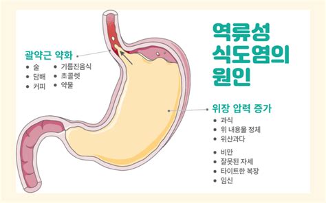 역류성 식도염 약국 약 2가지만 기억하세요 팜돌 역류성 식도염 약국 약 2가지만 기억하세요 팜돌