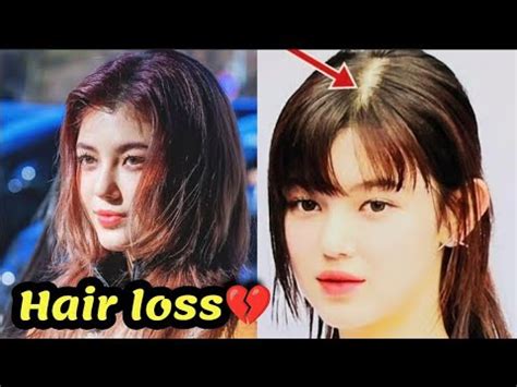 Fans Concerned About New Jeans Danielle Hair Loss She Almost Bald YouTube