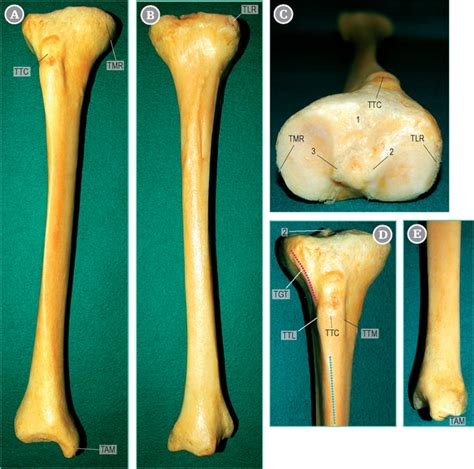Tibia Anterior Crest