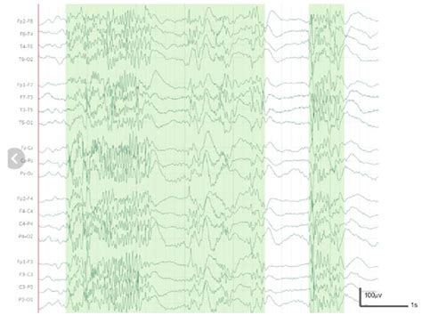 Typical Example Of A Generalized Paroxysmal Fast Activity Events Green Download Scientific