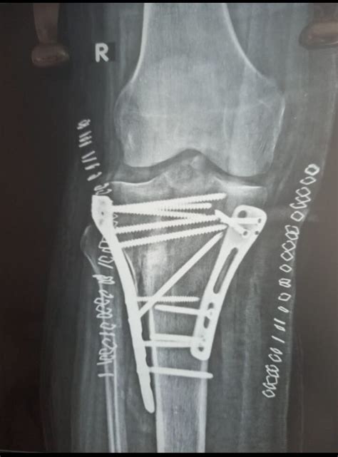 Dr 30 Year Old Young Male Patient With Right Bicondylar Proximal