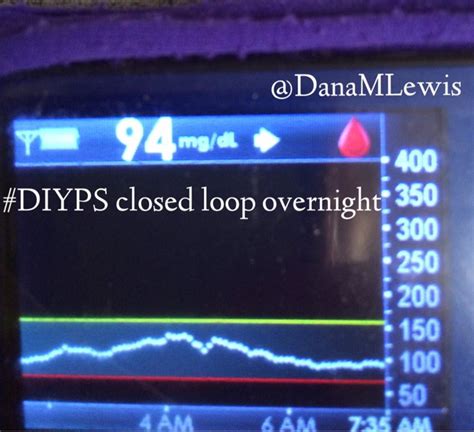 How Does A Closed Loop Artificial Pancreas Work When You Diy Or
