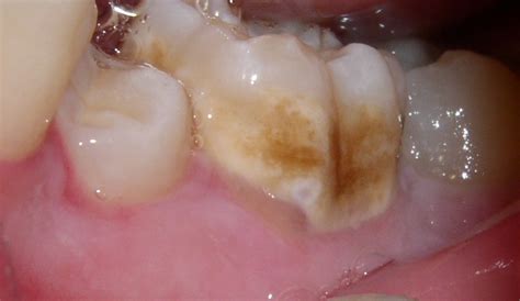 Enamel Hypocalcification Vs Enamel Hypoplasia