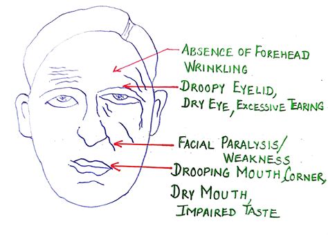 What Are Causes Of Bells Palsy
