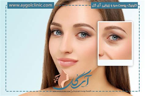 جراحی زیبایی چشم؛ انواع، تکنیک عمل، مزایا و عوارض آی گل