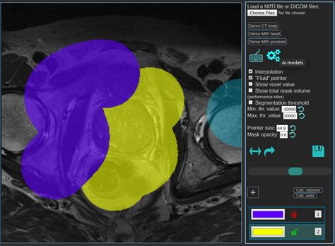 I Am Creating A Free Web Based Annotation Tool With Ai For Volumetry On Ct And Mri Rradiology