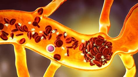 14 Coronary Artery Vasospasm Royalty Free Photos And Stock Images