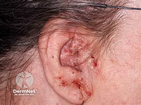 Otitis Externa Images — Dermnet