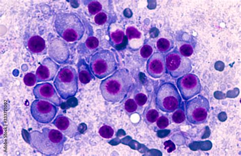 Multiple Myeloma Awareness Bone Marrow Aspirate Cytology Of Multiple
