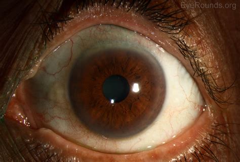 Limbic Sparing Conjunctivitis