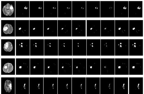 Table 1 From An Automatic Segmentation Of Brain Tumor From Mri Scans Through Wavelet