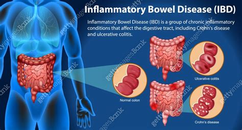 Inflammatory Bowel Disease Ibd Infographic 이미지 1471802755 일러스트 무료