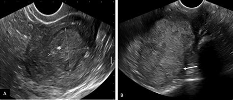 A Large Relatively Well Defined Iso To Hyperechoic Mass Lesion Download Scientific Diagram