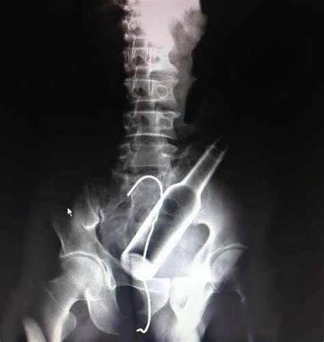 X Rays Of Foreign Objects Up Bums Savage Paramedics