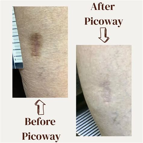 Picoway Before And After Results Premier Derm Center