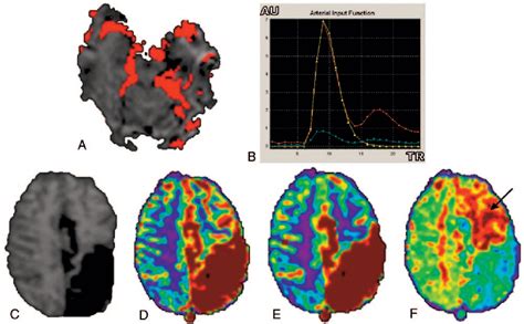 Figure 1 From Perfusion Measurement Of Arterial Input Function Extractions For Brain
