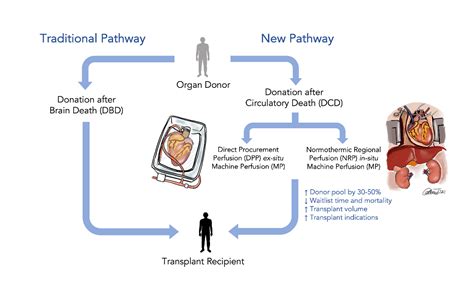 Normothermic Regional Perfusion Nrp Keystone Perfusion