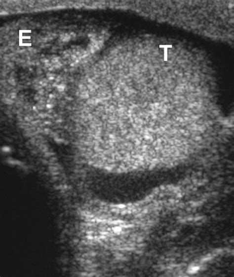 Sonographic Appearance Of The Epididymis In Pediatric Testicular