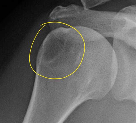 Pseudocyst Of The Humerus Radshare