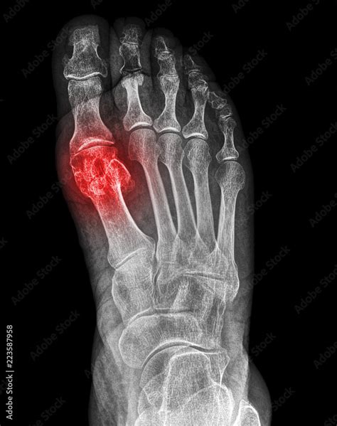Metatarsal Fracture Xray At Shawana Salvatore Blog