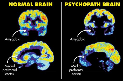 Two Mri Images Show The Different Areas Of The Brain And How They Are