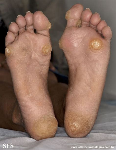 Palmoplantar Keratoderma Focal Keratoderma Nc Commons