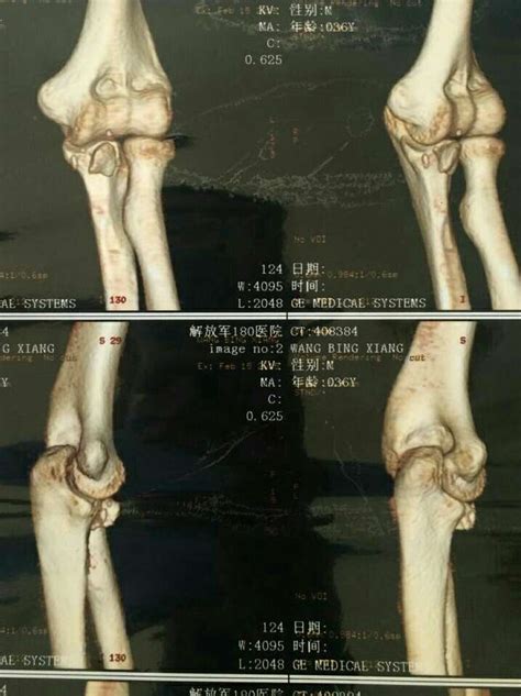 关节肘轻微骨裂的图片 大山谷图库