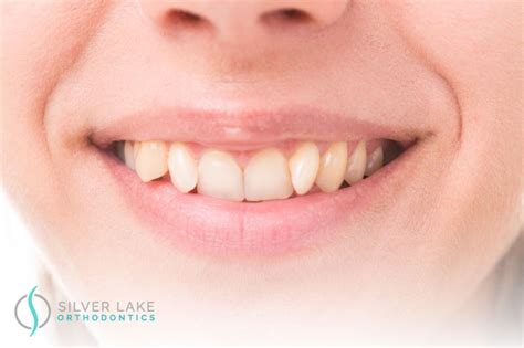 Orthodontic Problems And Causes For Crooked Teeth And Jaw Malocclusions