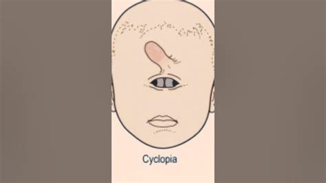 Cyclopia The Terrifying Truth About One Eyed Newborns Shorts Youtube