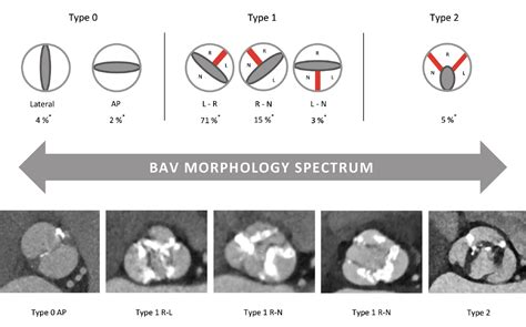 Tavr Versus Savr In Bicuspid Aortic Valve Stenosis Cardiac