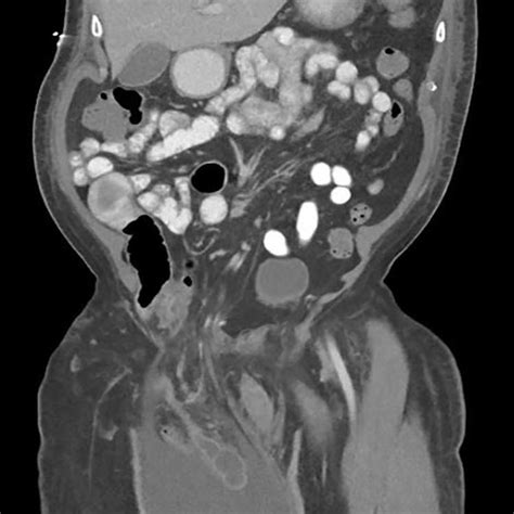 Ct Axial View Showing The Right Sided Inguinal Hernia Containing The