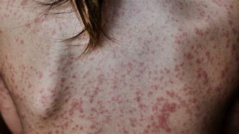 What Does A Strep Rash Look Like Torrinomedica