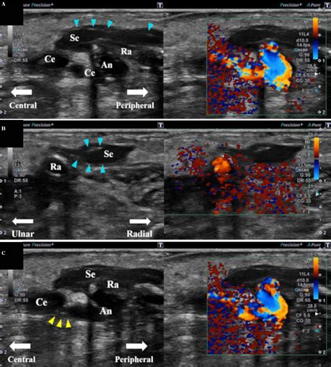 Figure 2 From Seroma As A Rare Complication Of Autologous Arteriovenous
