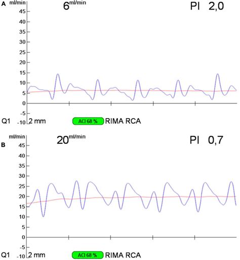 Transit Time Flow Measurement Of The Rima Rca Bypass Graft Before A Download Scientific Transit Time Flow Measurement Of The Rima Rca Bypass Graft Before A Download Scientific