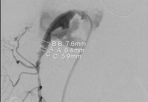Angiogram Revealing Dorsal False Aneurysm Of The Sma With Extravasation Download Scientific