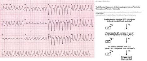 Trazado Ecg Que Presenta Una Taquicardia De Qrs Ancho Que Se Corresponde A Una Taquicardia