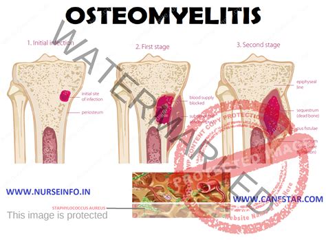 Management Of Chronic Osteomyelitis Of The Femur And Tibia A Osteomyelitis Of Femur Treatment