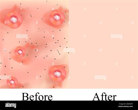 Serous Fluid Pimple