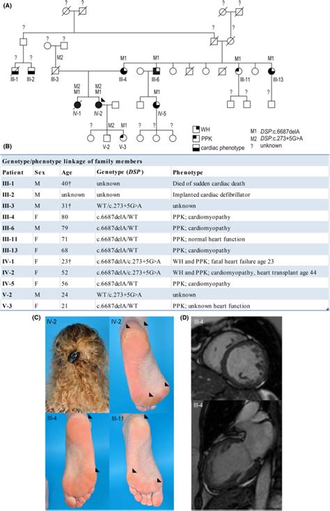 Functional Investigation Of Two Simultaneous Or Separately Segregating DSP Variants Within A